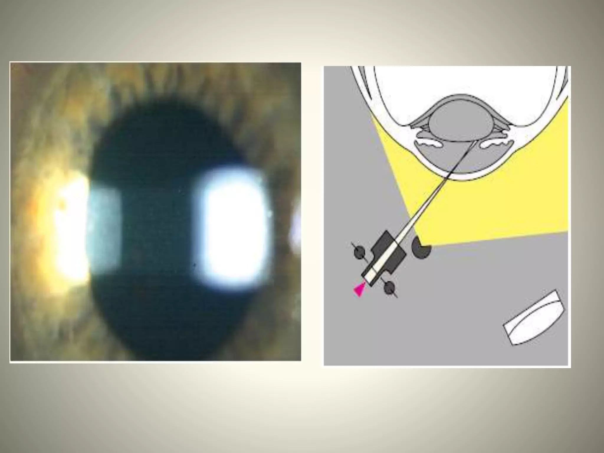 Slit lamp examination lecture | PPTX