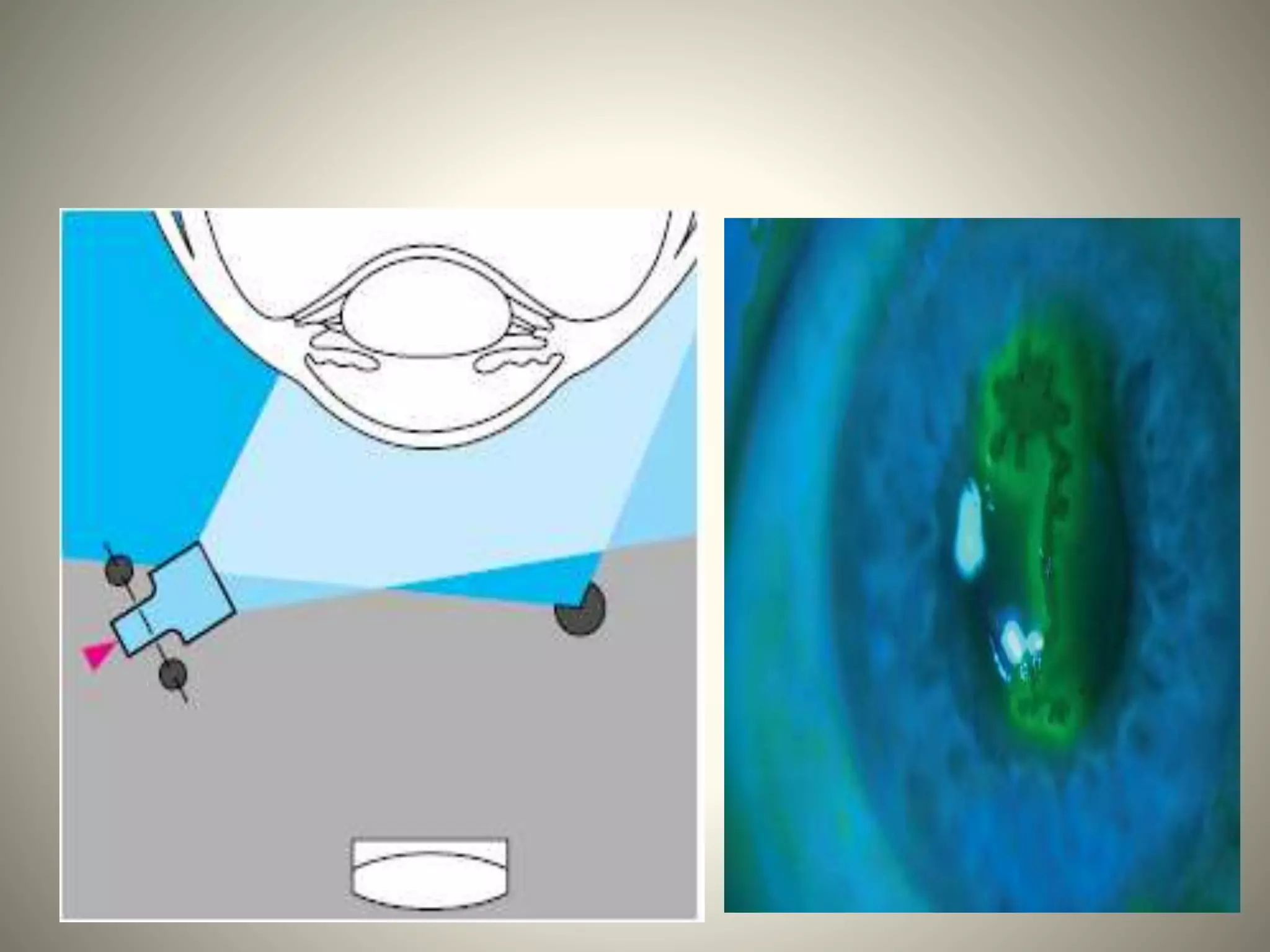 Slit lamp examination lecture | PPTX