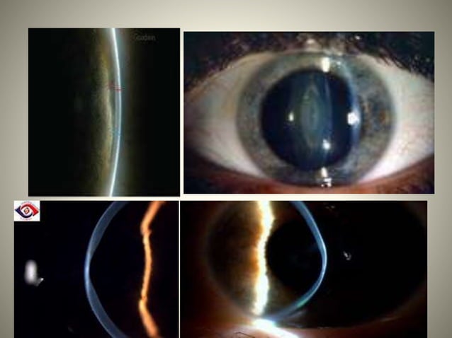 Slit lamp examination lecture | PPT