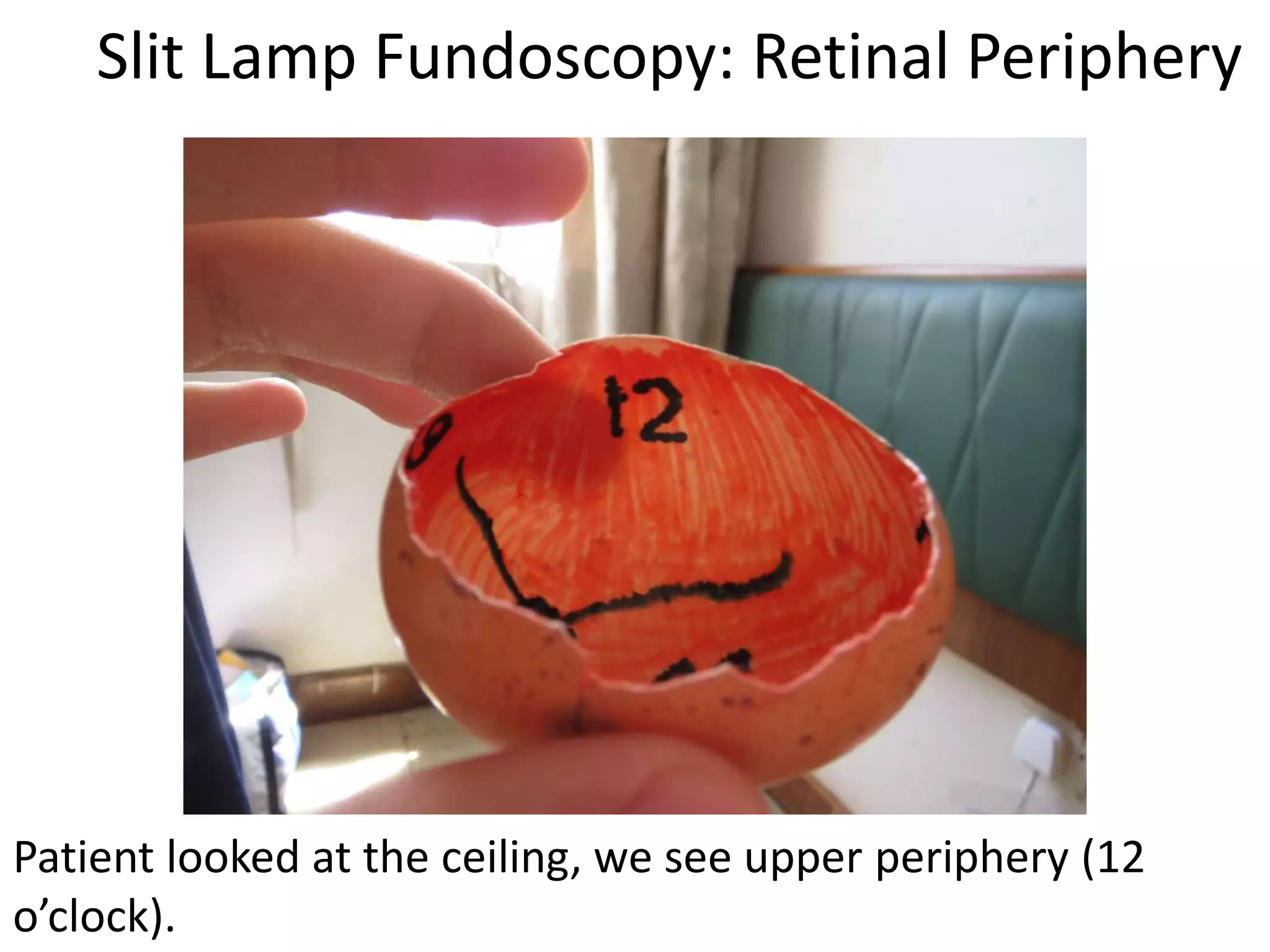 Slit lamp fundoscopy | PPTX