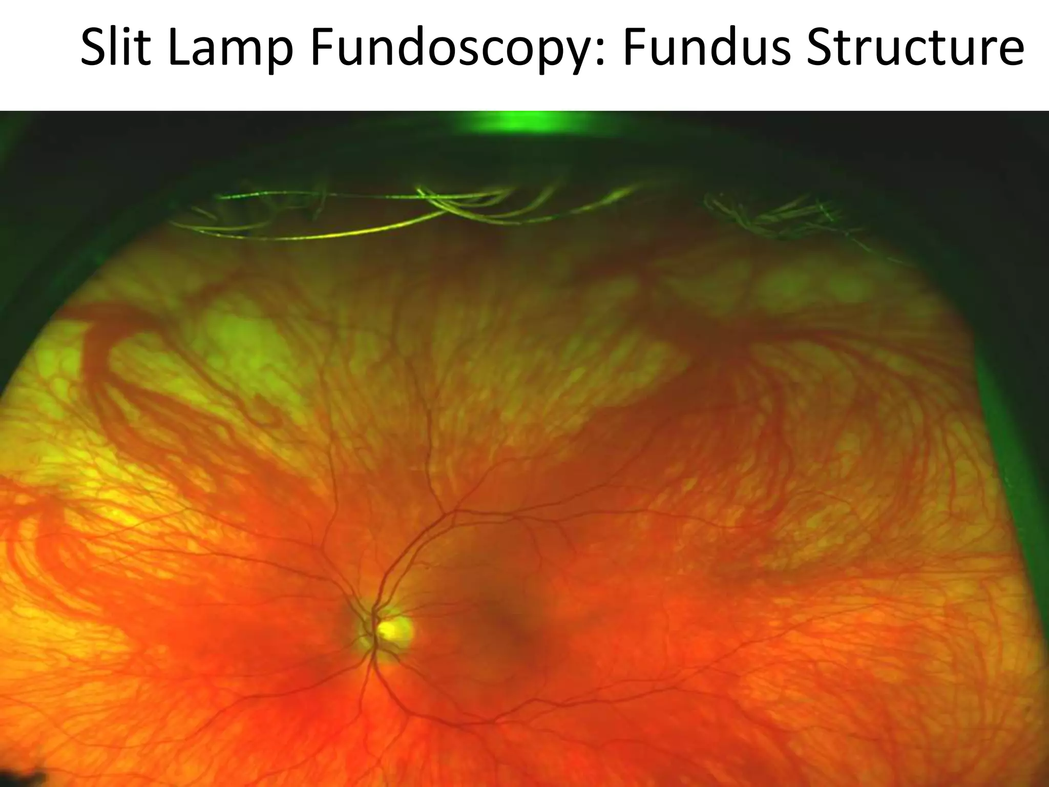Slit lamp fundoscopy | PPTX | First Aid | Injuries