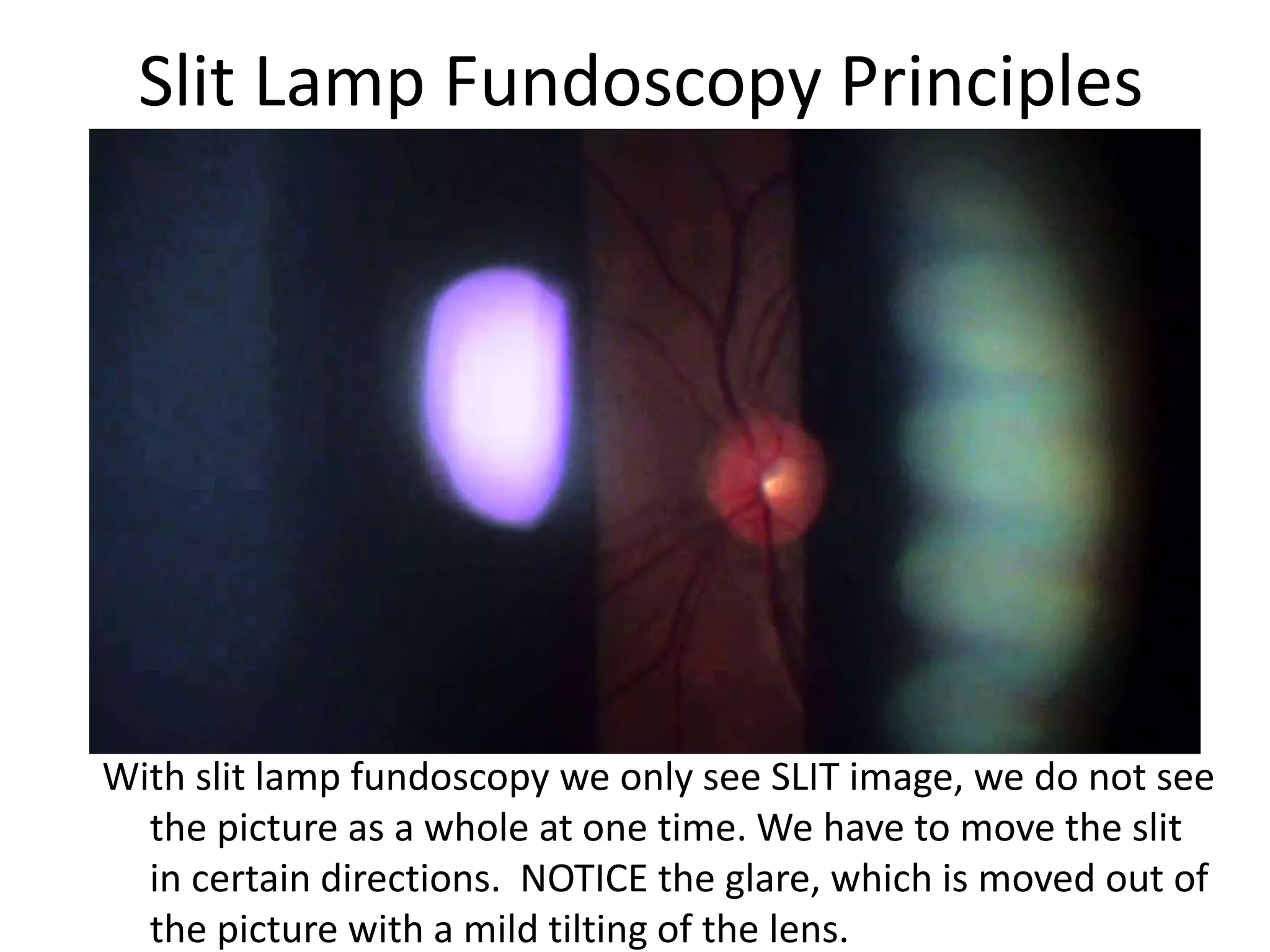 Slit lamp fundoscopy | PPTX