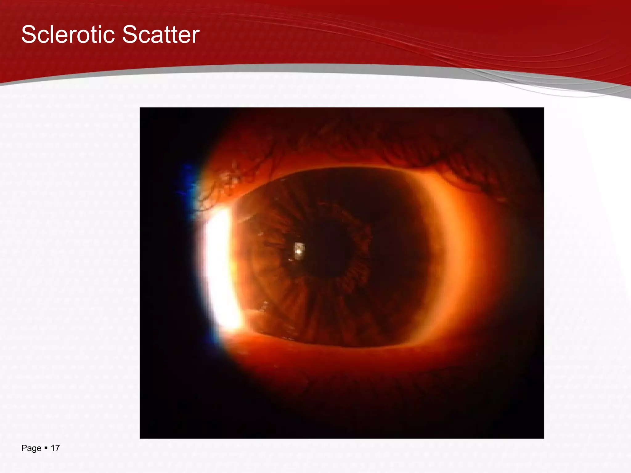Slit Lamp Illumination Techniques | PPT