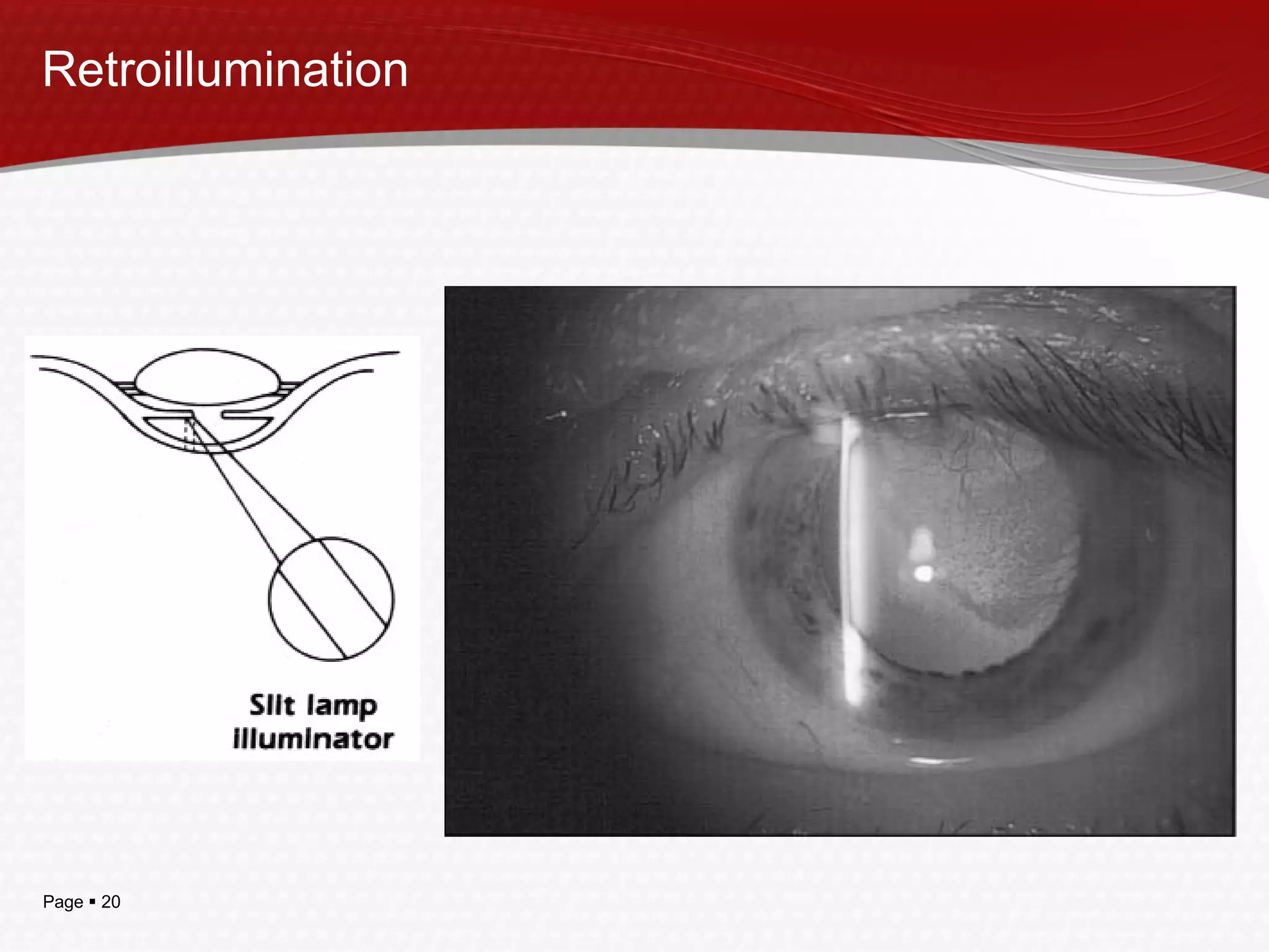 Slit Lamp Illumination Techniques | PPT