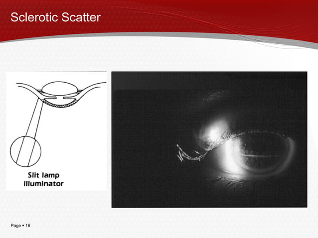 Slit Lamp Illumination Techniques | PPT | Eye and Vision Conditions ...