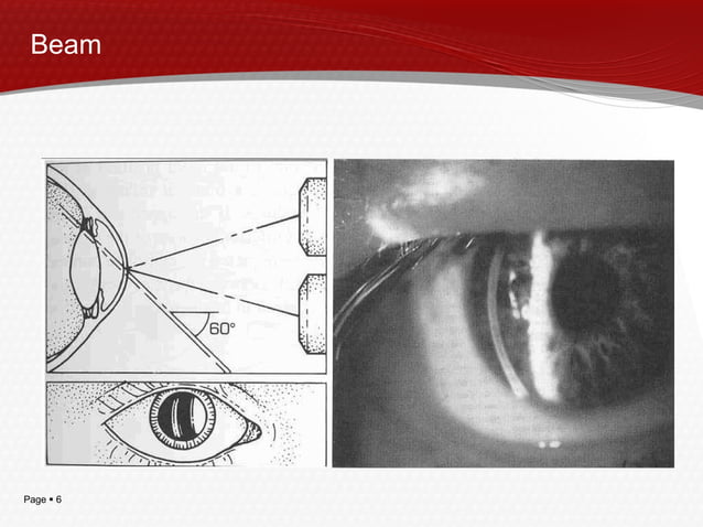 Slit Lamp Illumination Techniques | PPT | Eye and Vision Conditions ...