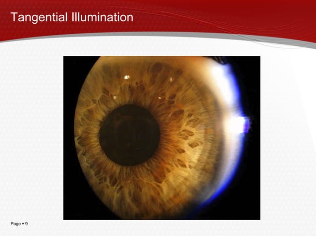 Slit Lamp Illumination Techniques | PPT | Eye and Vision Conditions ...