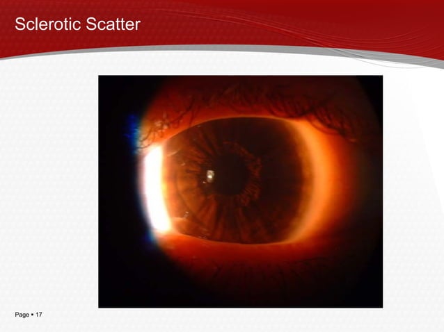 Slit Lamp Illumination Techniques | PPT