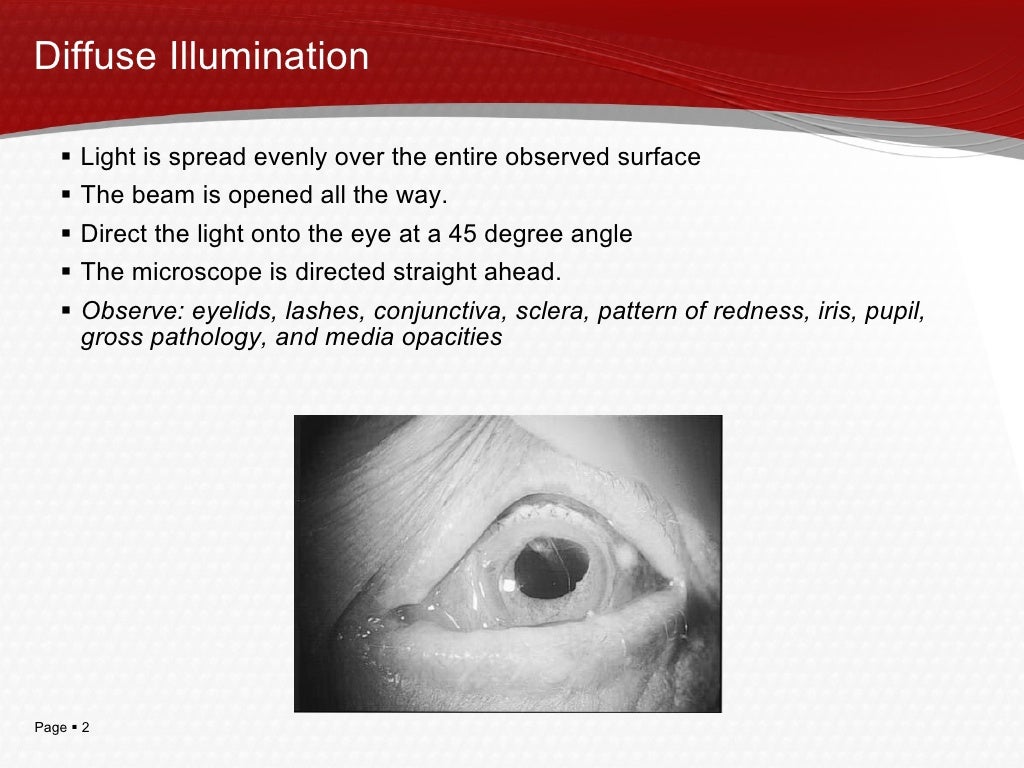 Slit Lamp Illumination Techniques