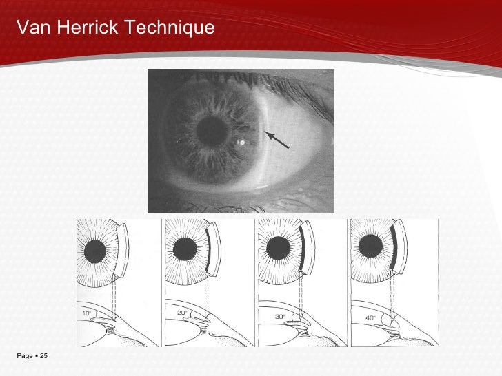 Slit Lamp Illumination Techniques