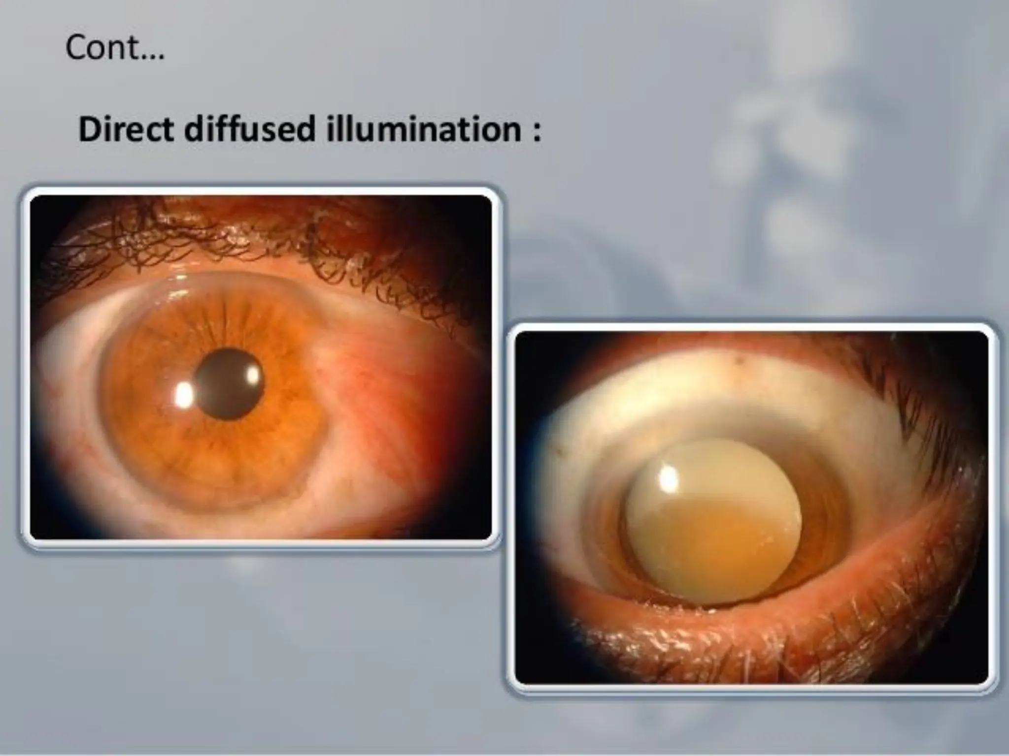THE SLIT LAMP BIOMICROSCOPE PRESENTATION | PDF