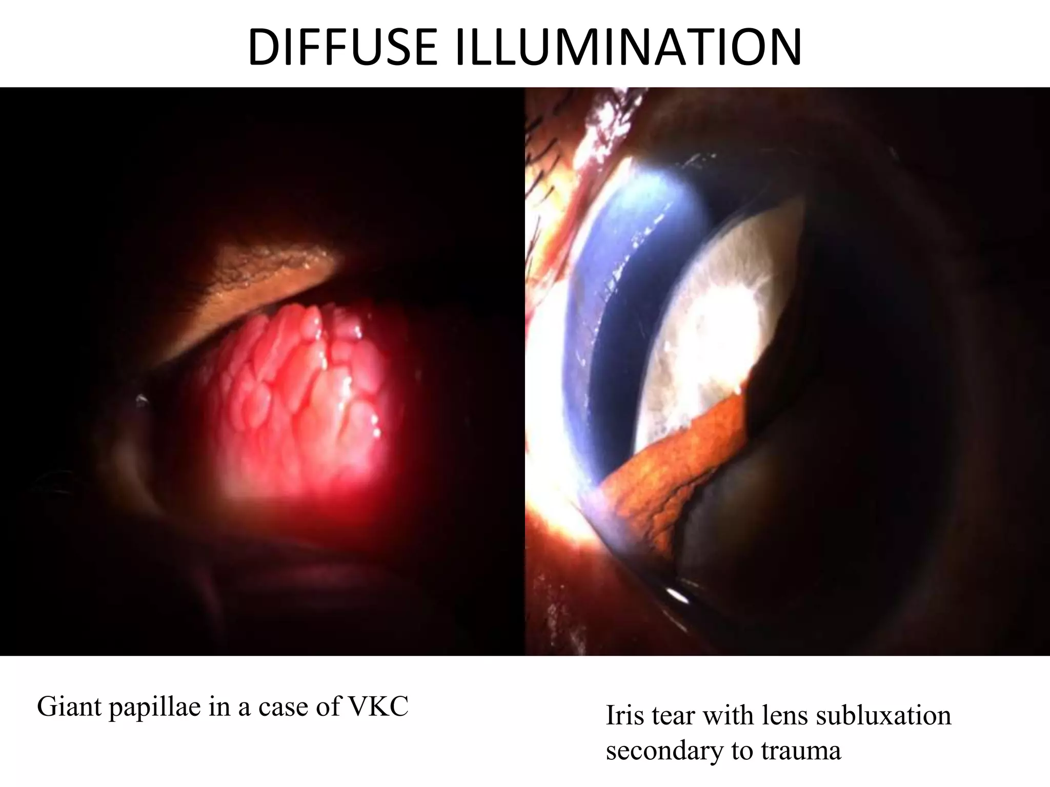 Slit lamp techniques.pptx