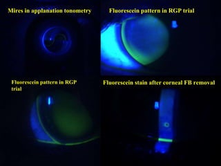 Slit lamp techniques.pptx