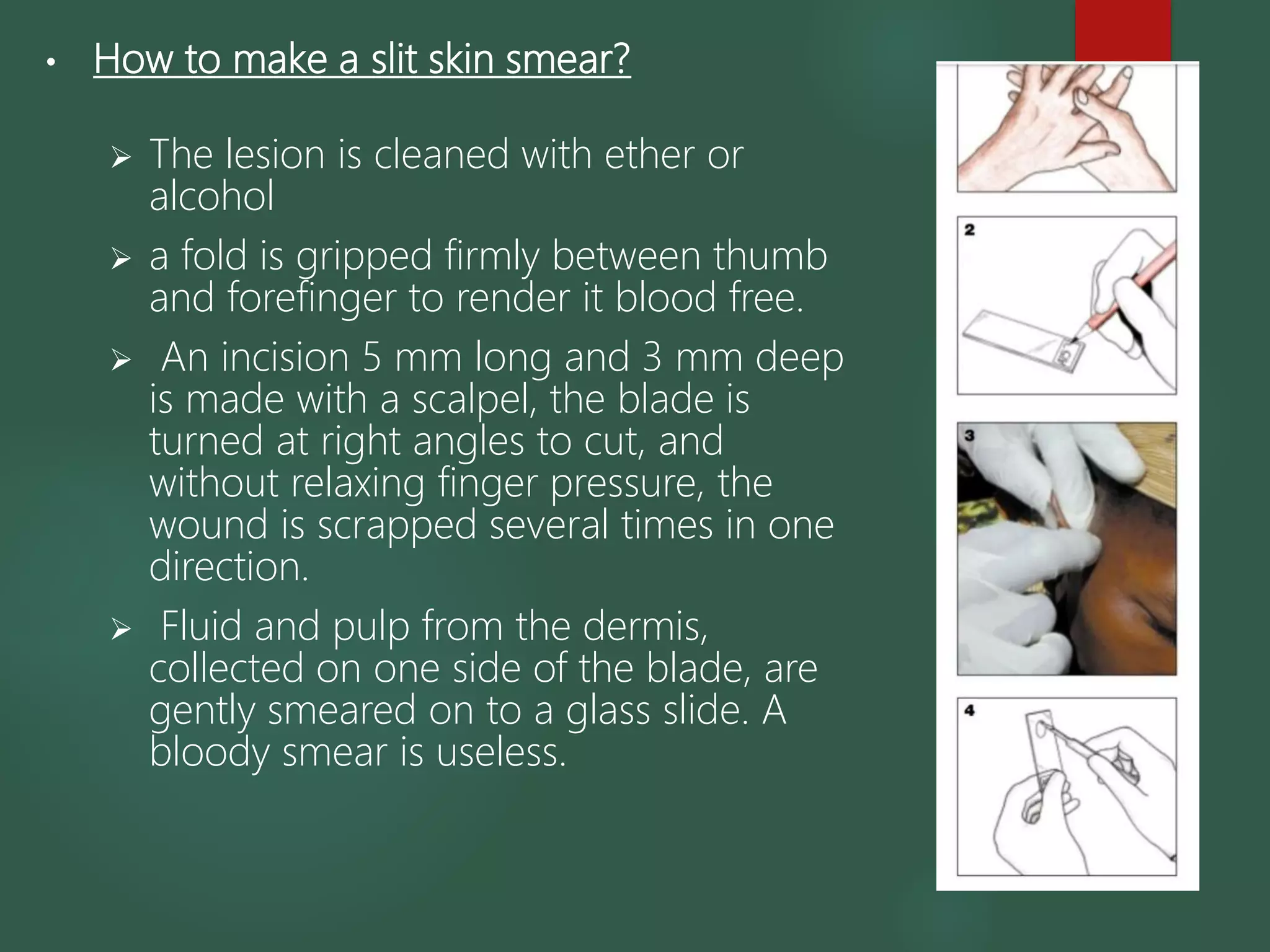 Slit skin smears | PPTX