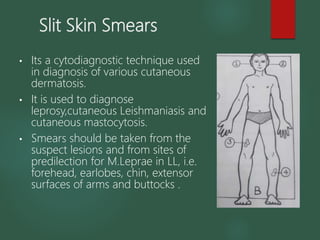Slit skin smears | PPTX
