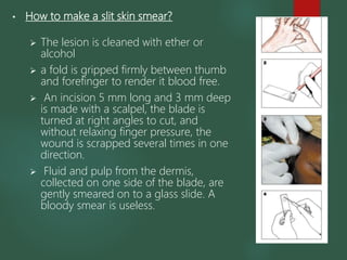 Slit skin smears | PPTX | Skin and Dermatology | Diseases and Conditions