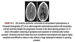 Slit ventricles syndrome - Dr Sameep Koshti (Consultant Neurosurgeon) | PPT