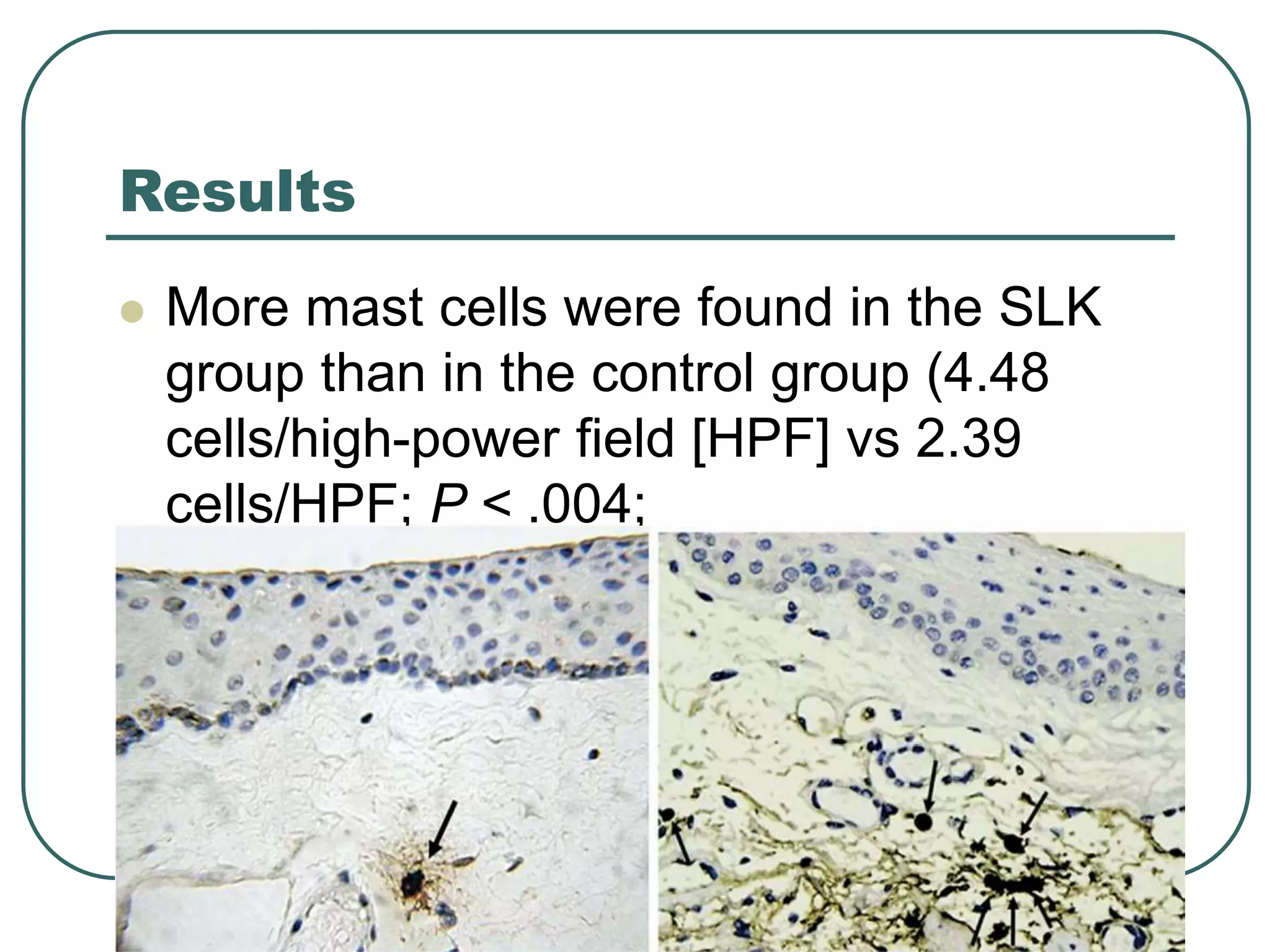 Superior limbic keratoconjunctivitis | PPT | Eye and Vision Conditions ...