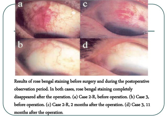 Superior limbic keratoconjunctivitis | PPT | Eye and Vision Conditions ...