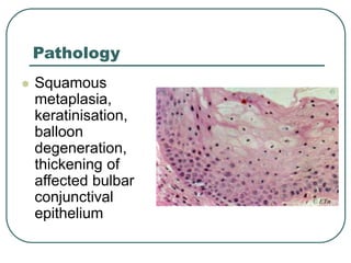 Superior limbic keratoconjunctivitis | PPT