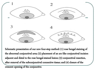 Superior Limbic Keratoconjunctivitis