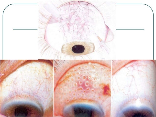 Superior limbic keratoconjunctivitis