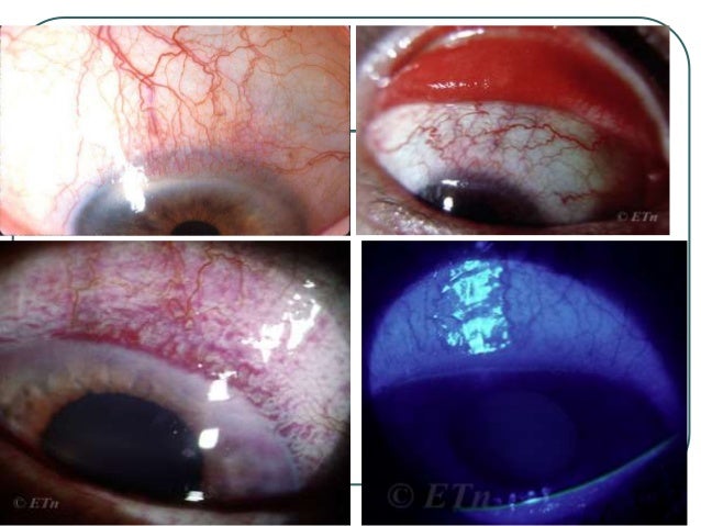 Superior limbic keratoconjunctivitis