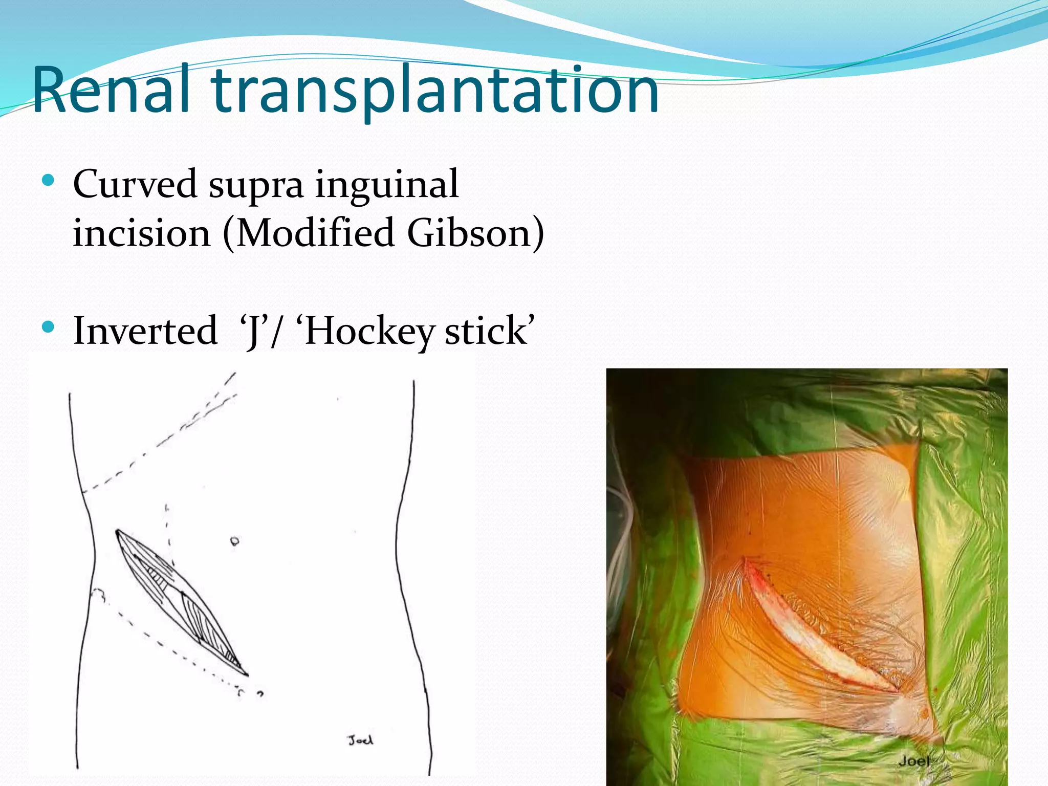 Kidney transplantation - Challenges and Experiences, SLMA Solid Organ ...