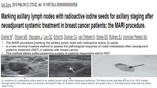 sentinel lymph node post neoadjuvant | PPT