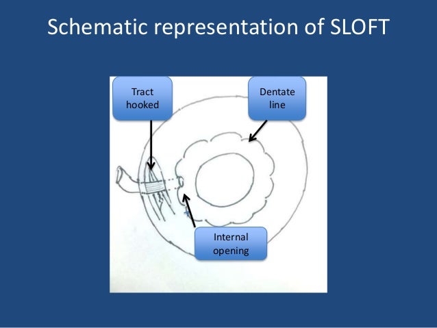 Fistula in ano new operation Sloft (Submucosal Ligation Of Fistula Tr…