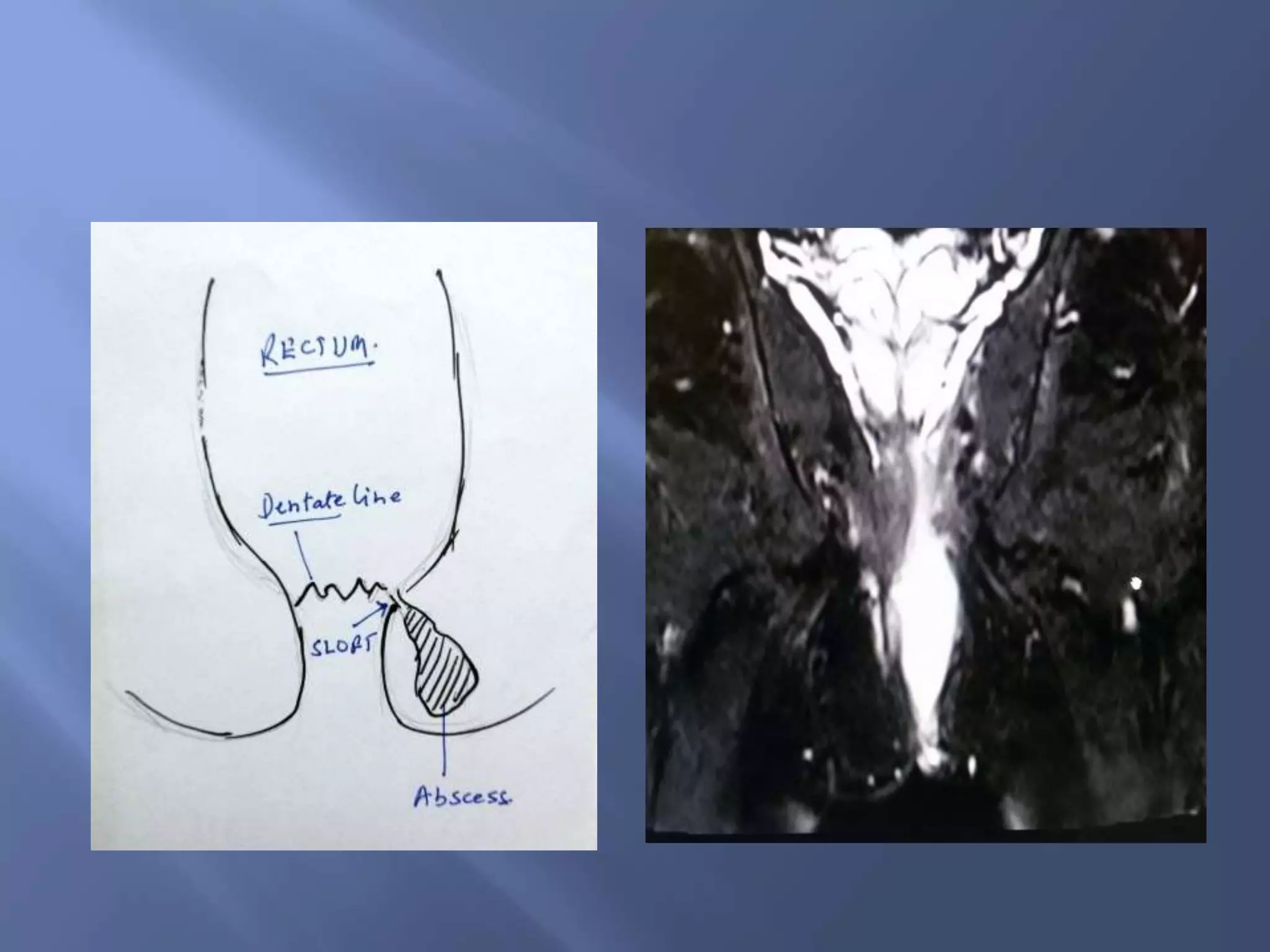 Sloft in ischio rectal abscess