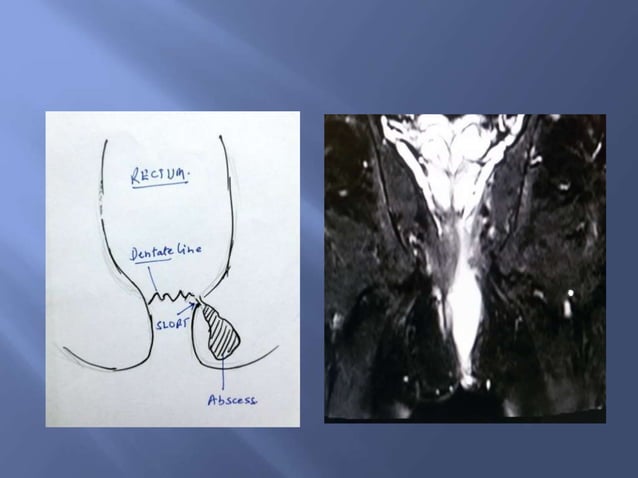 Sloft in ischio rectal abscess | PPTX