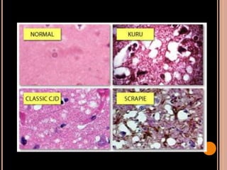 Slow virus diseases | PPTX