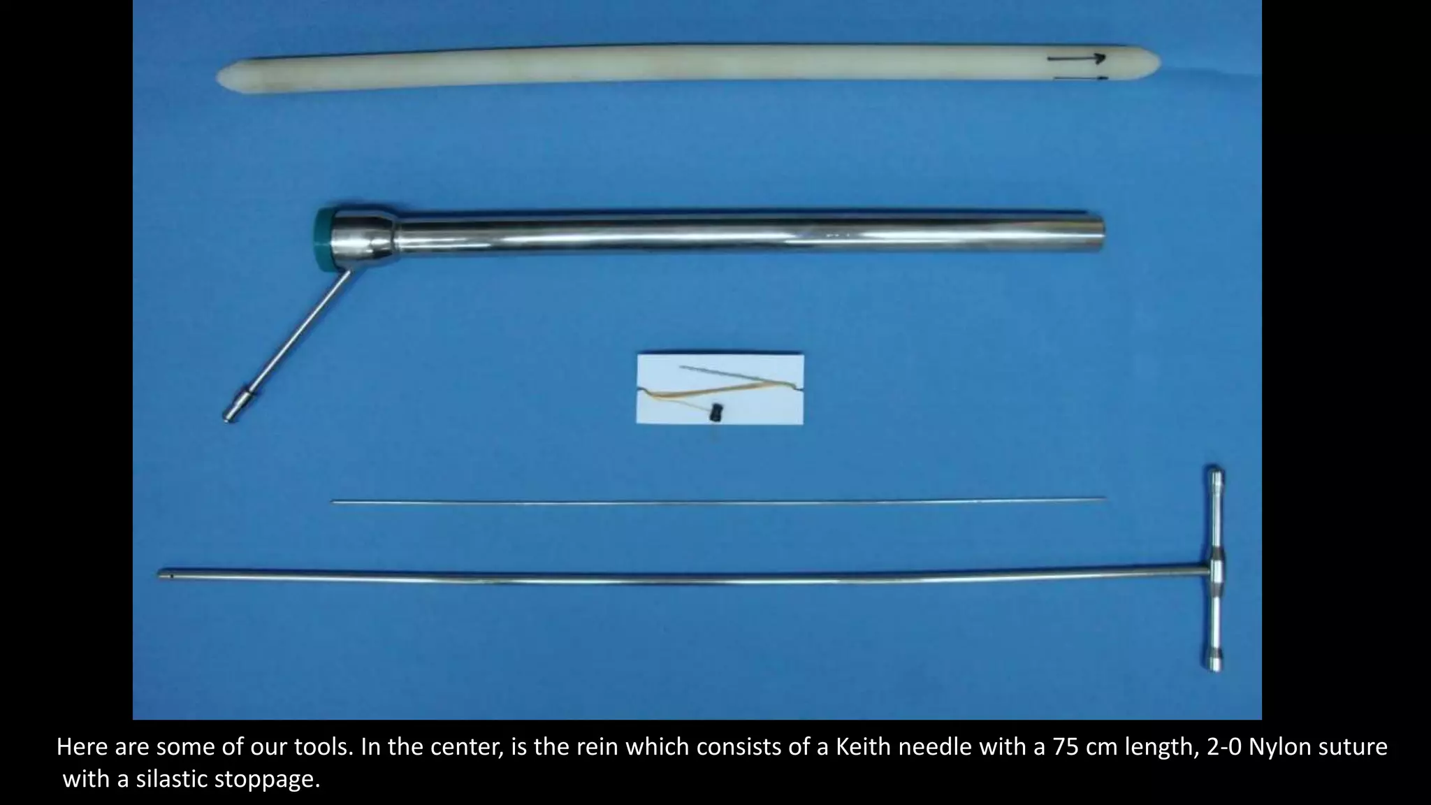 Culdolaparoscopy Cholecystectomy with Percutaneous Needle Assistance | PPTX