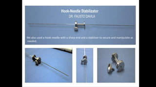 Culdolaparoscopy Cholecystectomy with Percutaneous Needle Assistance | PPTX