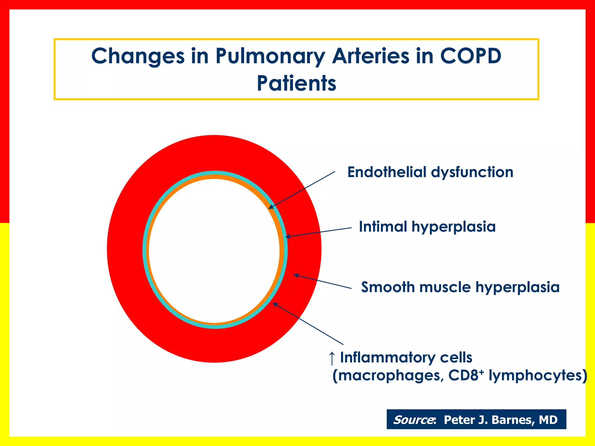 Chronic Obstructive Pulmonary Disease | PPTX