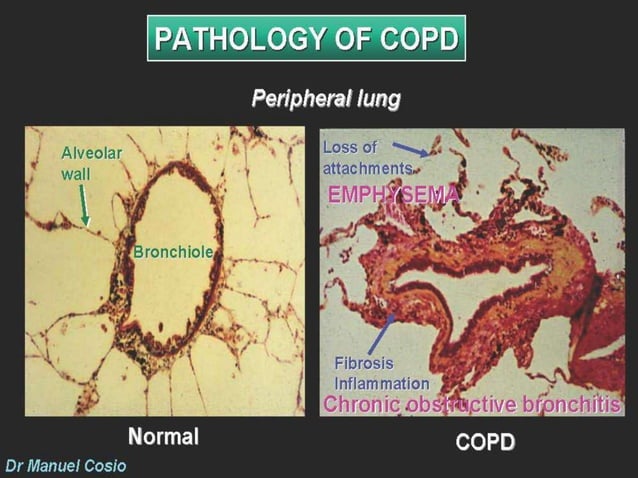 Chronic Obstructive Pulmonary Disease | PPTX | Lung and Respiratory ...