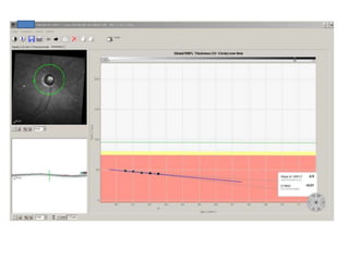 緑内障初期治療としてのSLT(Slt for first line glaucoma treatment ) | PPTX