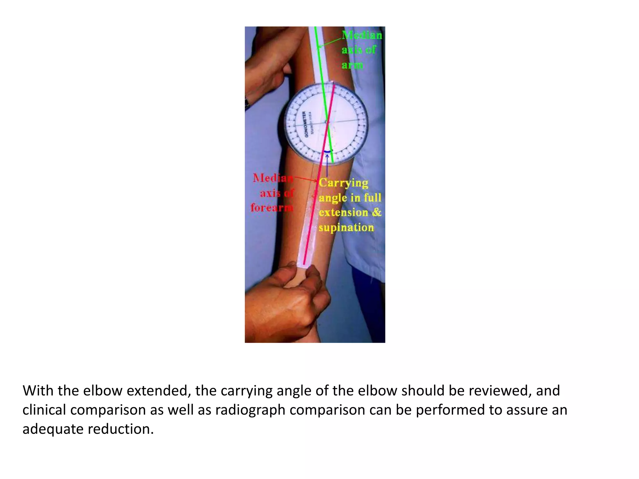 Carrying Angle | PPTX