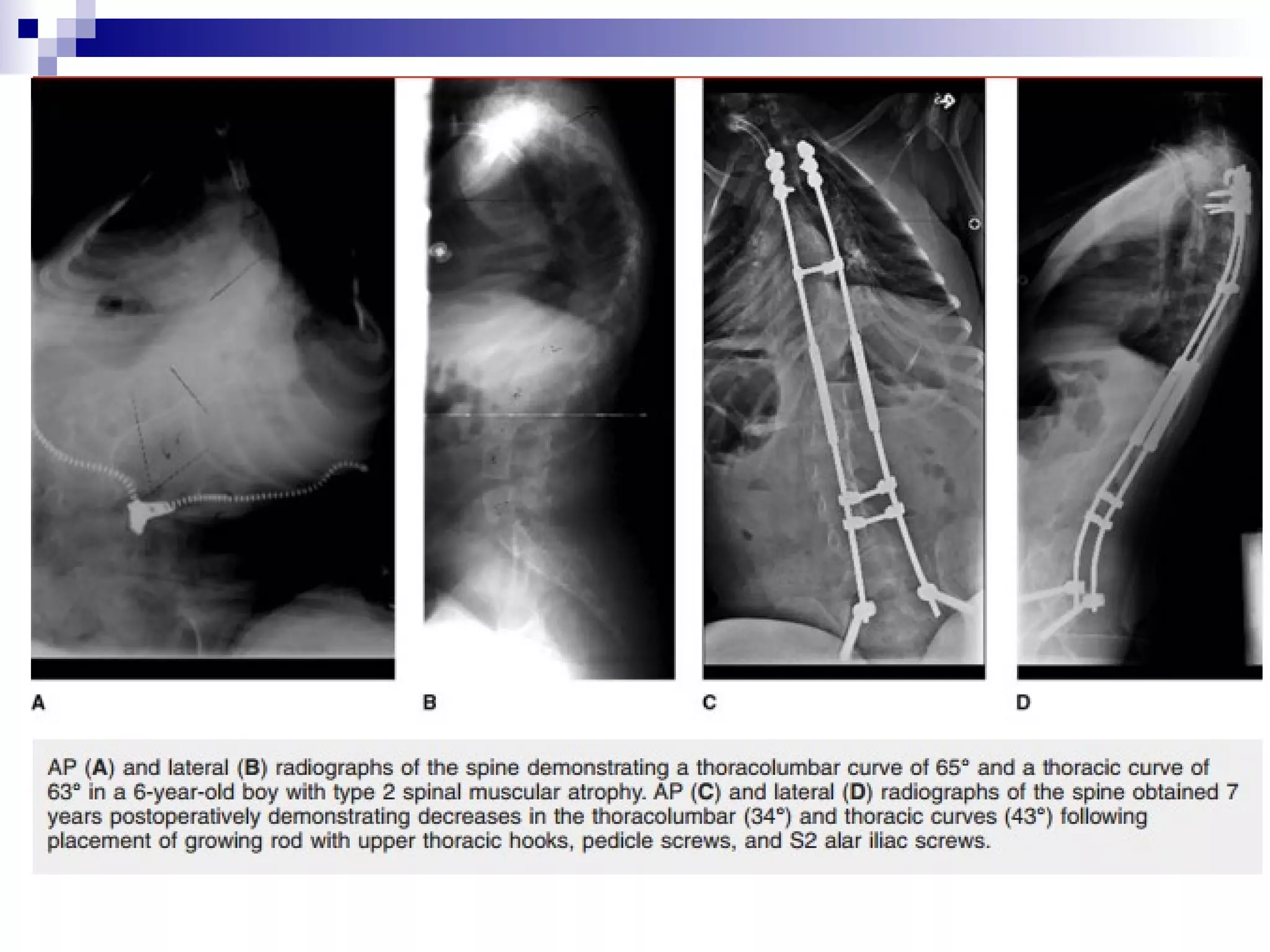 Spinal muscle atrophy | PPT