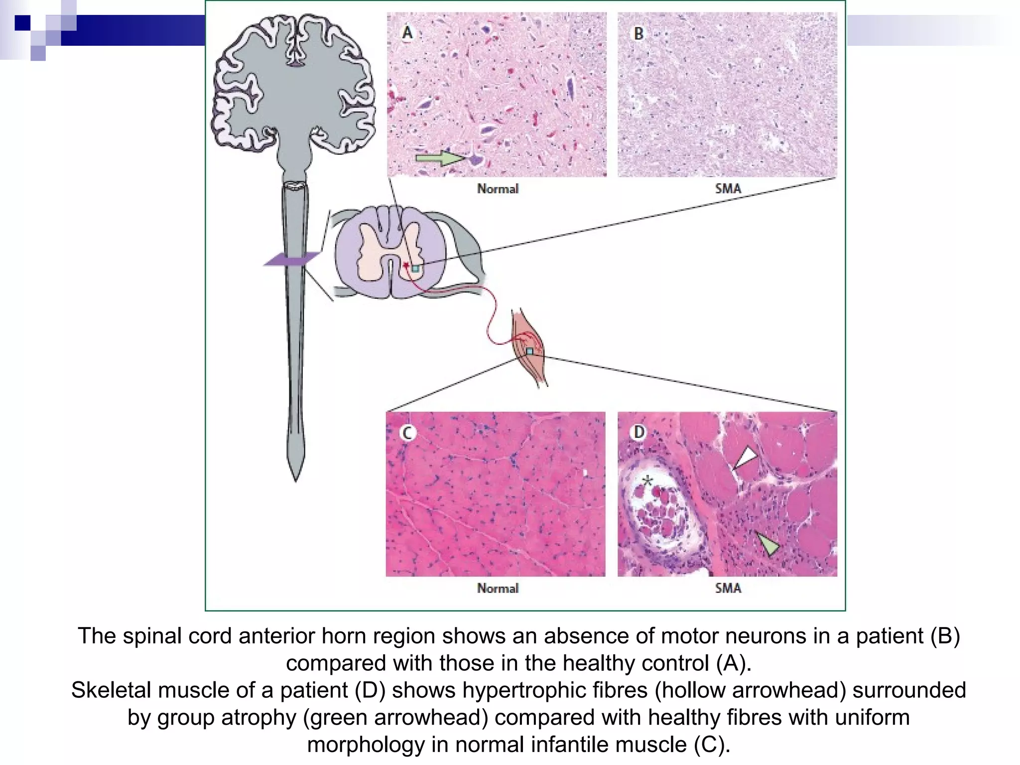 Spinal muscle atrophy | PPT