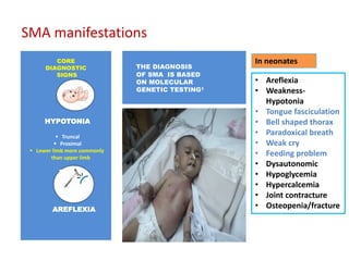SMA.pdf | Physical Therapy | Wellness