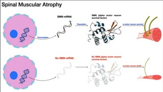 Spinal muscular atrophy, pathophysiology, genetics | PPTX