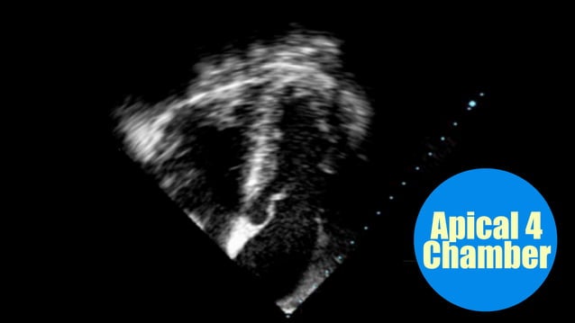 Airway Ultrasound: Confirming Endotracheal Tube Placement | PDF