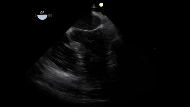 Airway Ultrasound: Confirming Endotracheal Tube Placement | PDF
