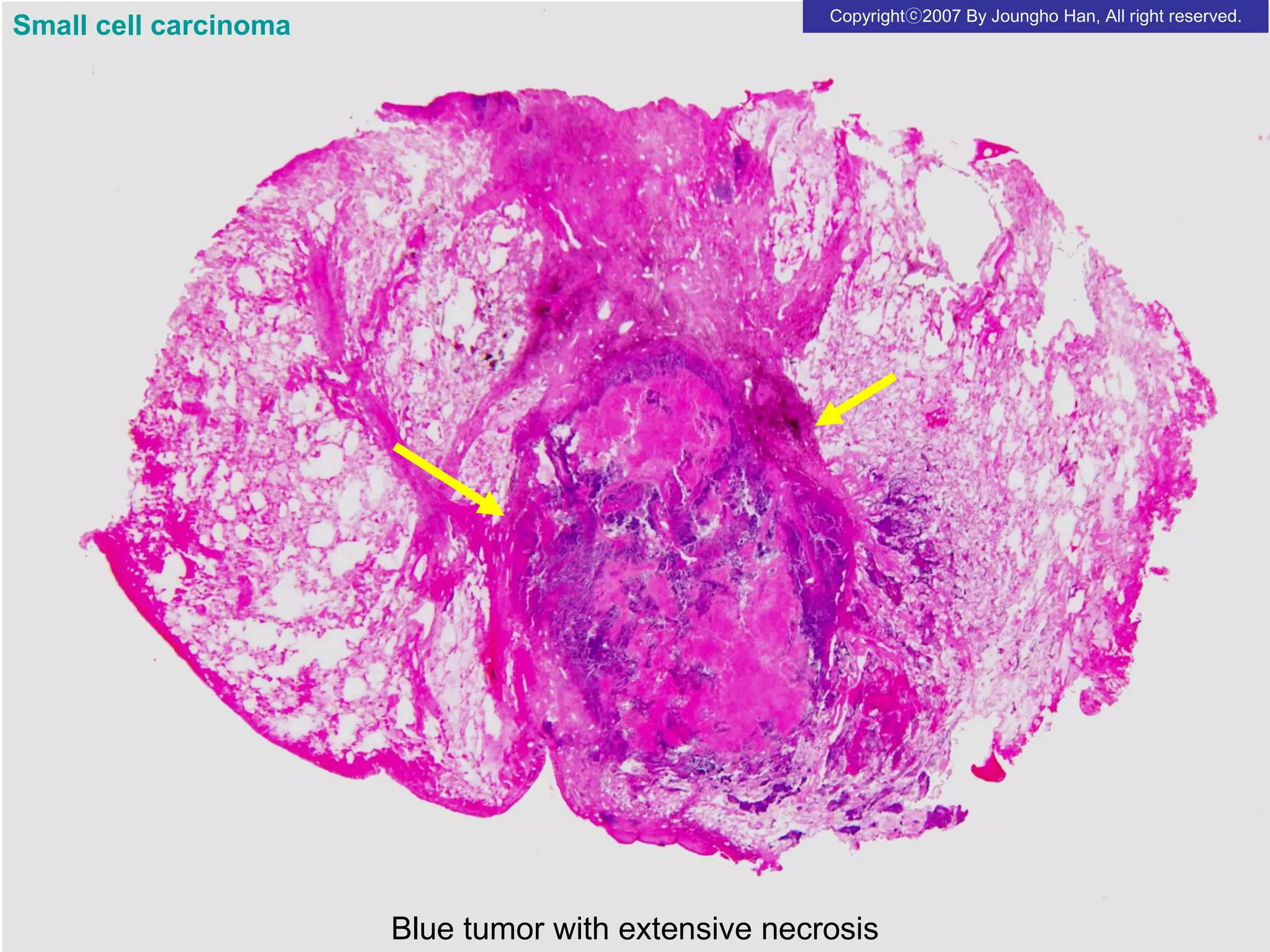 small cell carcinoma | PPS