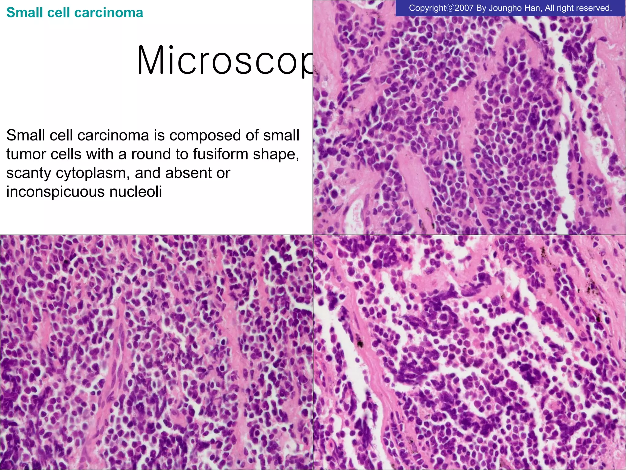 small cell carcinoma | PPS