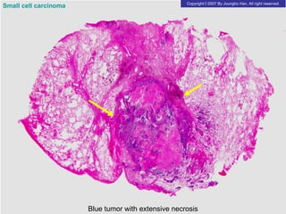 small cell carcinoma | PPS