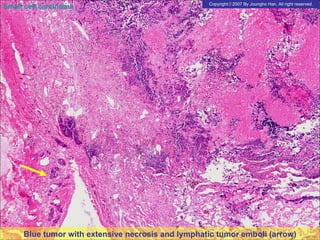 small cell carcinoma | PPS