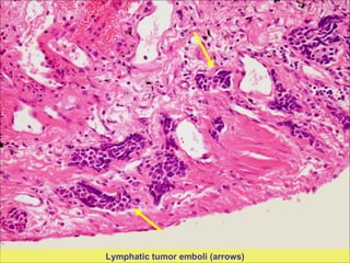 small cell carcinoma | PPS